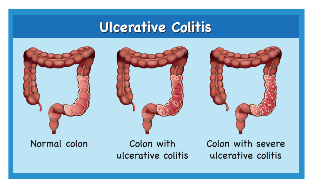 Understanding Ulcerative Colitis: Causes, Symptoms, and Treatment ...